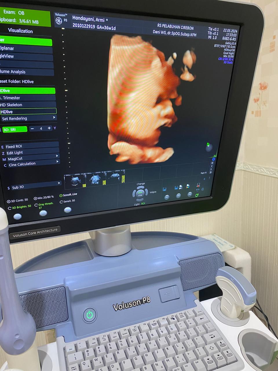 Ultrasonografi (USG) 4 Dimensi